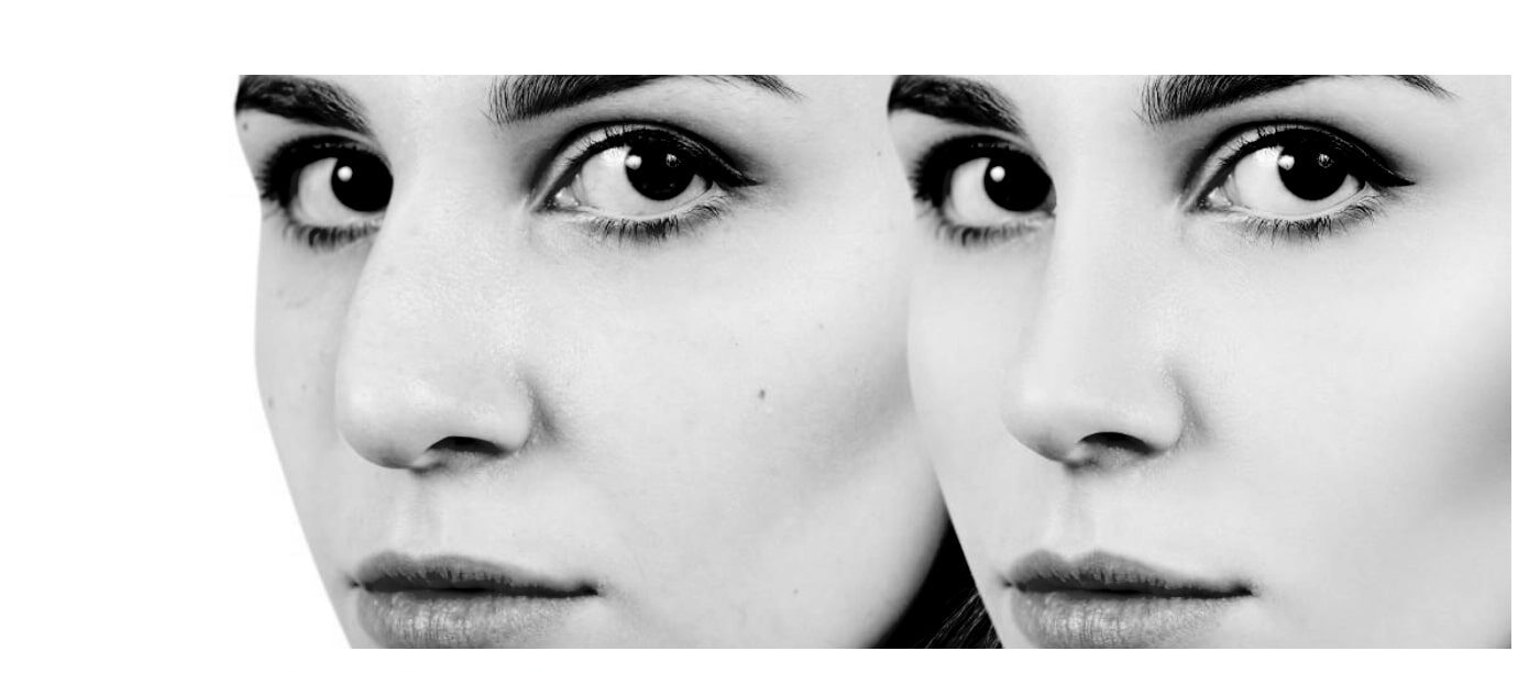 Types of Rhinoplasty - GRAND GENESIS PLASTIC SURGERY