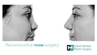 What is Rhinoplasty or Nose Surgery? | Nose Job in Toronto - GRAND ...