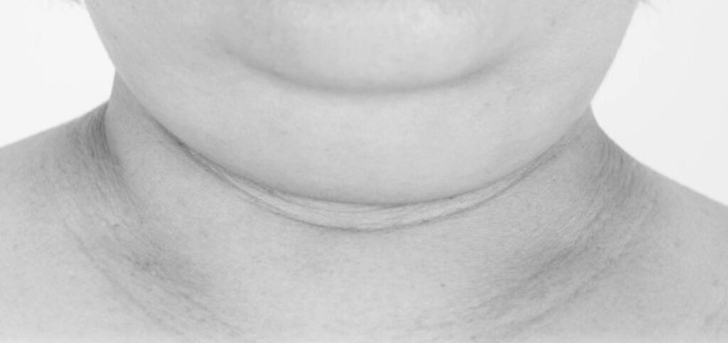 How can I tighten the skin under my chin? | Is a chin augmentation ...