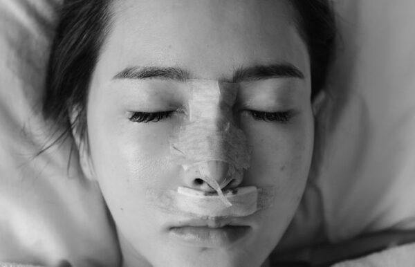 Rhinoplasty Stitches: What to Expect After Nose Surgery - GRAND GENESIS ...