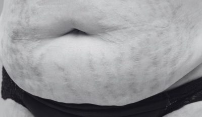 The Best Non-Surgical Weight Loss Solutions in 2025: Why Intragastric ...